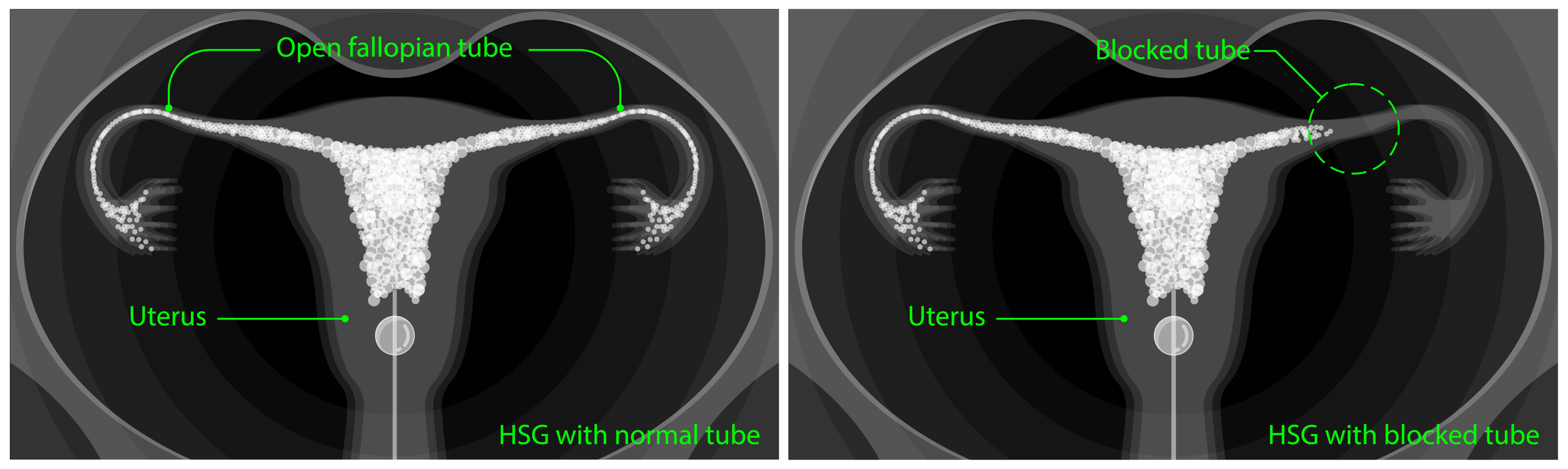 Hysterosalpingogram HSG Test For Fallopian Tubes